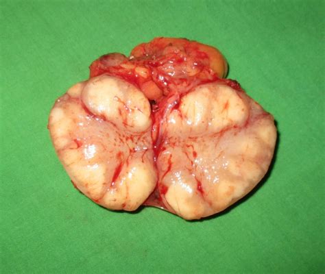 Armpit Lymph Node Tuberculosis Rojoson Medical Clinic