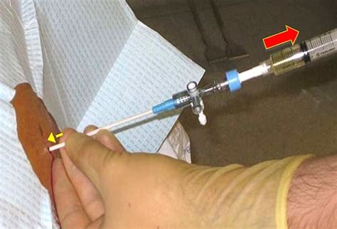Paracentesis Equipment