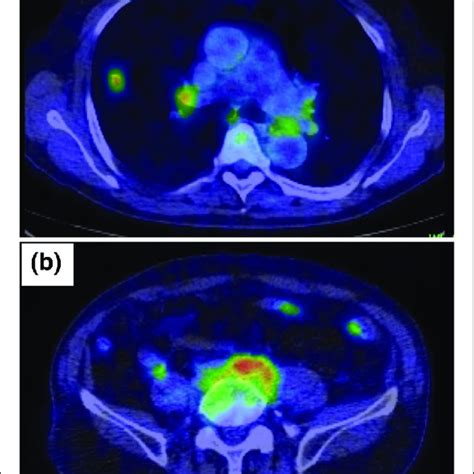 Physiology Of Cannula Induced Phlebitis Download Scientific Diagram
