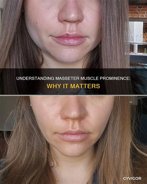 Understanding Masseter Muscle Prominence Why It Matters Cyvigor