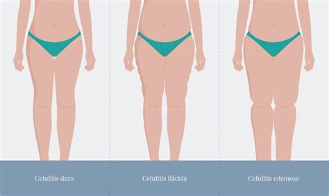Que Es La Celulitis Y Cuantos Tipos Existen Celulitis Qué Es Cómo
