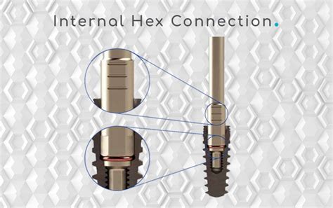 The Internal Hex Implant Connection And Its Famous Inward Migration R Dental Implants