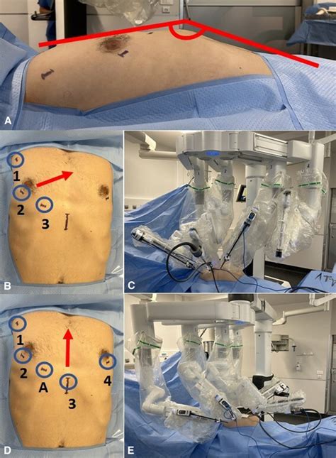 Totally Robotic Assisted Thymectomy With A Bilateral And Subxiphoid