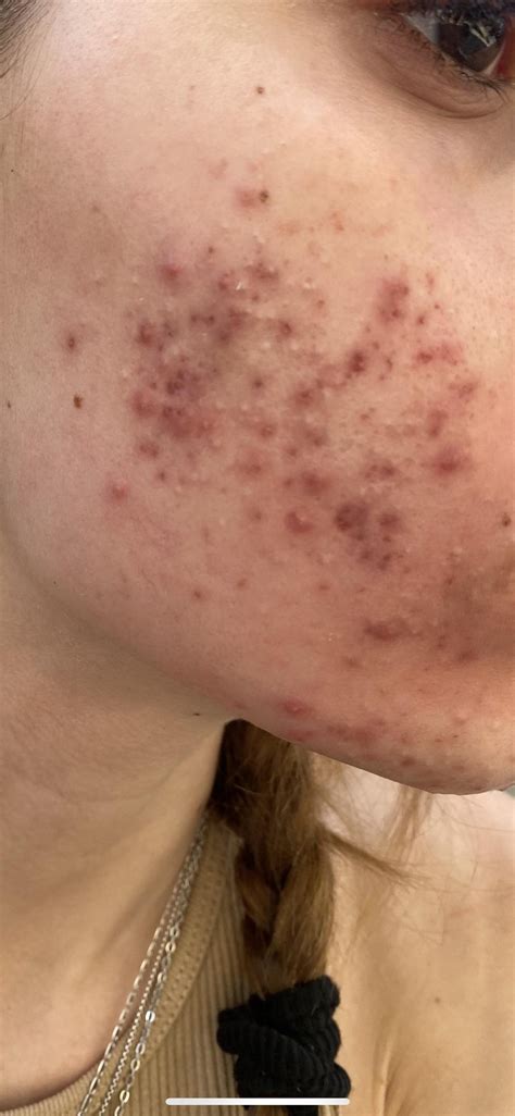 Accutane Saved My Face Be Patient Guys Raccutane