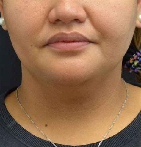 Coolsculpting Chin Before And After Photos Sculpt Md Medspa