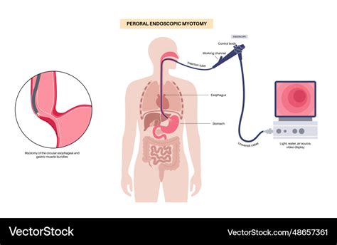 Stricture Vector Images Over 1 500