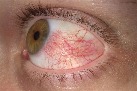 Uveitis Types Symptoms And Treatments In Turkey
