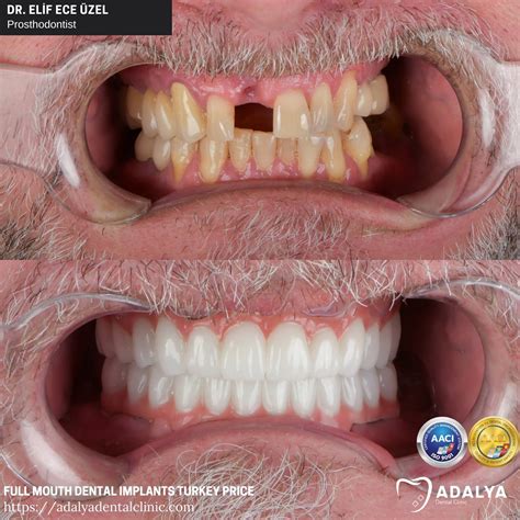 Full Mouth Dental Implants Turkey Price 2026 Adalya