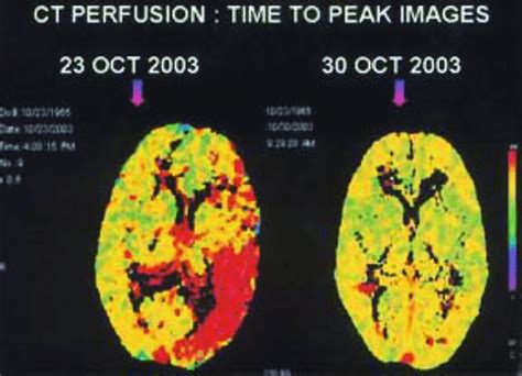 Perfusion Ct Showing A Delay In Time To Peak Perfusion At The Posterior