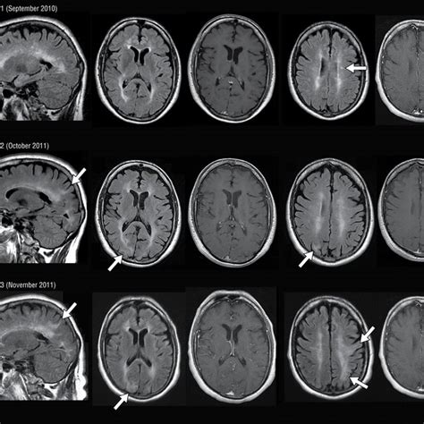 Brain Mri Showing Bilateral Multifocal White Matter Lesions The