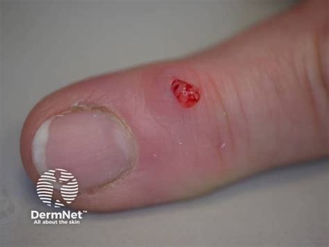 Digital Myxoid Cyst Images