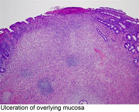 Pathology Outlines Inflammatory Fibroid Polyp