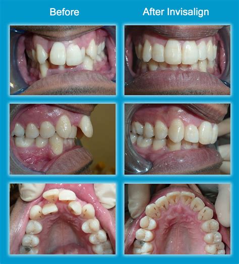 Invisalign Before And After Buck Teeth