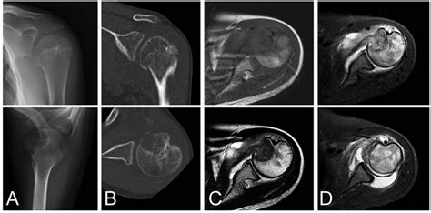 Chondroblastoma In Left Humerus Of A 13 Year Old Female Plain
