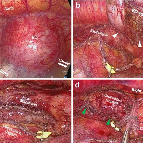 Intraoperative Findings A Tight Adhesion Between The Epiphrenic Download Scientific Diagram