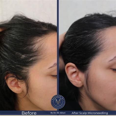 Scalp Microneedling Monarch Md And Hair Lab Md