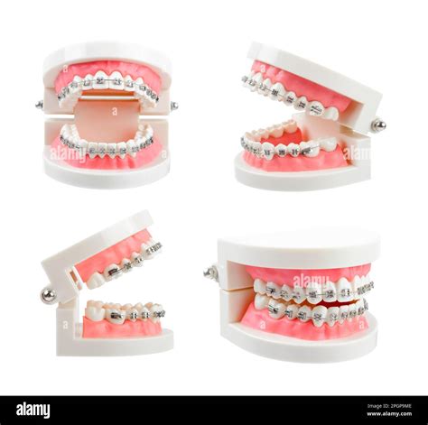 Braces Set Of Teeth At Laci Briggs Blog