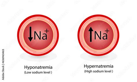 Hypernatremia High Plasma Sodium Level And Hyponatremia Low Plasma