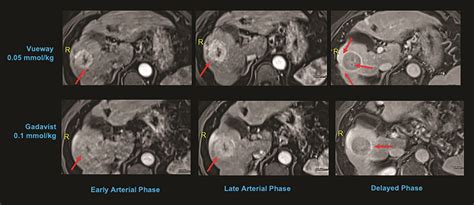 Vueway™ Gadopiclenol Practical Considerations For Use Applied Radiology
