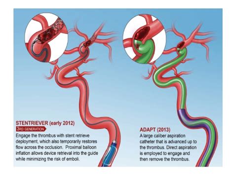 Thrombectomy