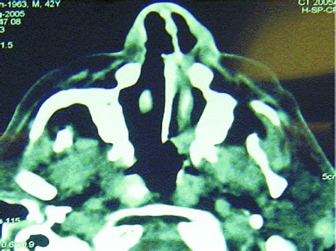 Computed Tomography Axial Scan Of Ethmoid Sinuses Showing A Partial Download Scientific Diagram