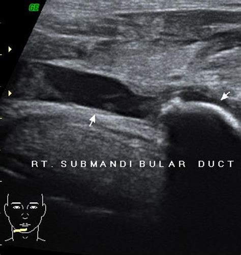 Submandibular Duct Stone