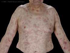 Macular Rash Across Arms And Trunk Download Scientific Diagram