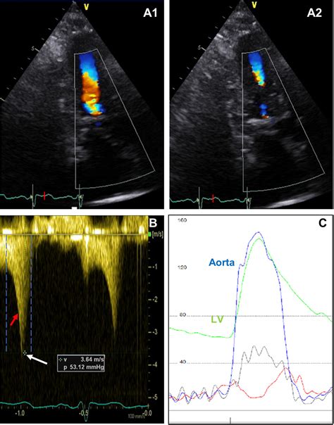Obstruction In Hypertrophic Cardiomyopathy Many Faces Journal Of The