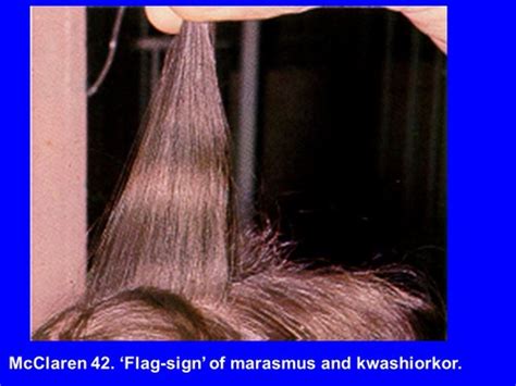 Nfpe Micronutrient Deficiencies Hair Flashcards Quizlet