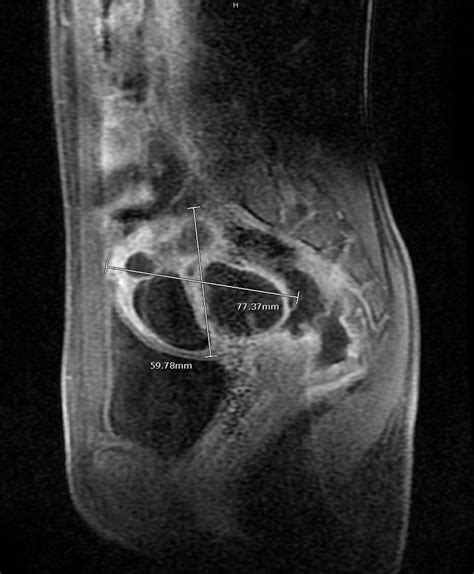 The Dangers Of Hymenotomy For Imperforate Hymen A Case Of Iatrogenic