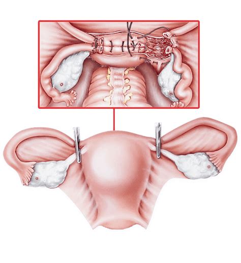 Hysterectomy Rosamond Greenfield