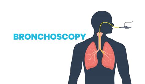 Bronchoscopy Uses Procedure And Risks