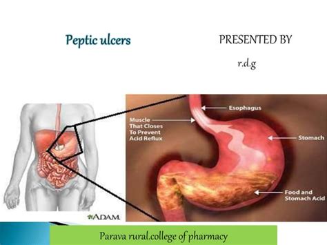 Peptic Ulcers Pathophysiology Pptx