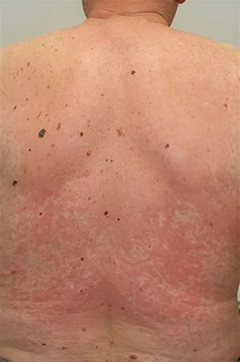 药物的皮肤副反应（一）：发疹性药疹腾讯新闻