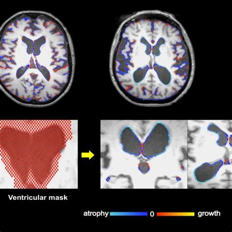 Pdf Longitudinal Whole Brain Atrophy And Ventricular Enlargement In