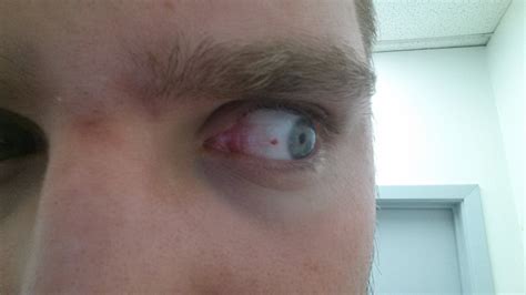Why Is There A Red Dot In My Eye