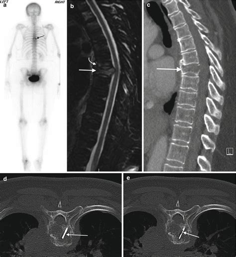 Thoracic Spine Biopsy Radiology Key