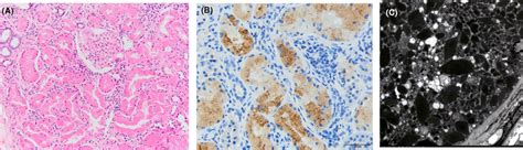 Renal Biopsy Findings Light Microscopic Photomicrographs Of Glomeruli