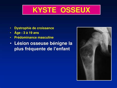 Ppt Kyste Osseux Kyste Solitaire Powerpoint Presentation Free Download Id 507080