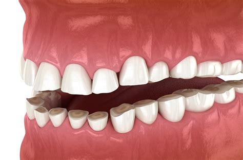 Teeth Grinding Dental Specialists In Ipswich Excellence At Ids