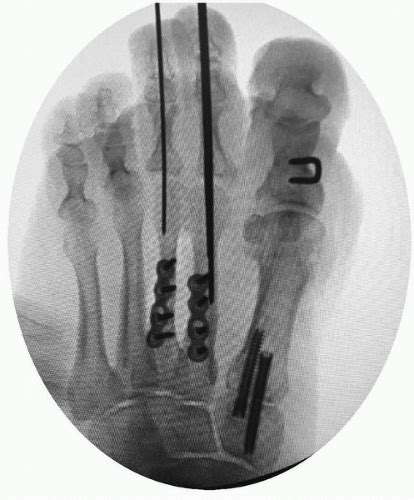 Management Of Lesser Toe Deformity Pip Arthroplasty And Extensor