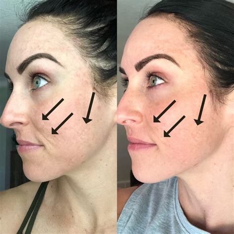 How Long Should You Wait To Wear Makeup After Microneedling Saubhaya