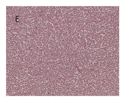 A Small Round Blue Cell Neuroectodermal Tumor A He Without Download Scientific Diagram