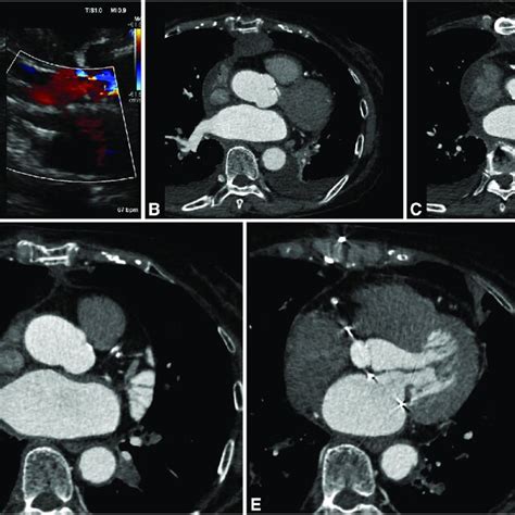 Postoperative Echocardiographic Image And Computed Tomography Angiogram