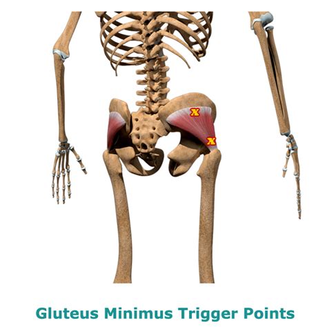 Gluteus Minimus Trigger Point