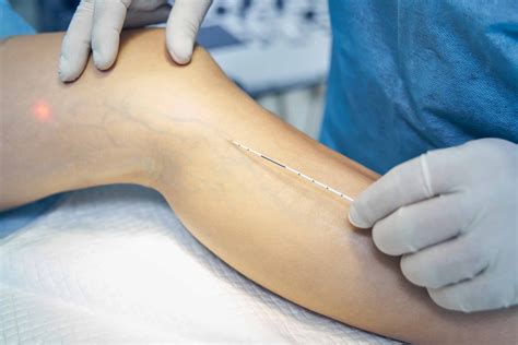 Varicose Vein Removal Surgery Cosmetic Surgery In Turkey