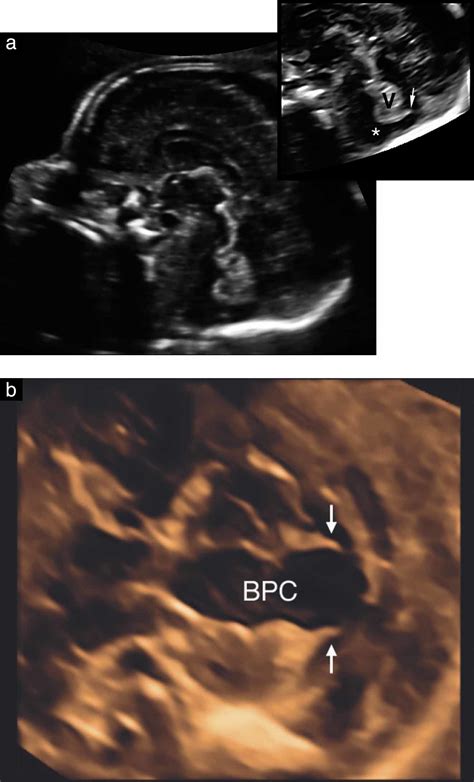 Prenatal Diagnosis Of Blakes Pouch Cyst Following First‐trimester