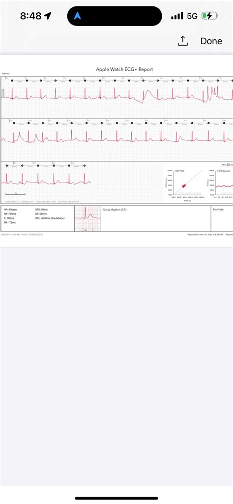 Is This Normal I Been Diagnosed With Afib Rafib