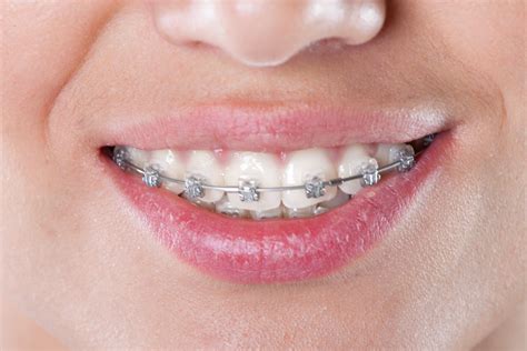 Clear Braces A Modern Discreet Solution For Straighter Teeth