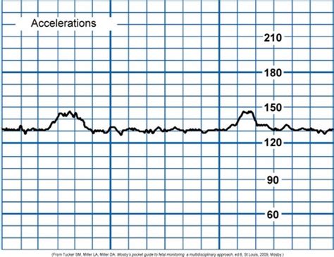 Efm And Fetal Well Being Flashcards Quizlet